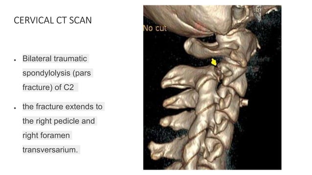 C2 (Axis) cervical Spine Fracture Presentation | PPTX