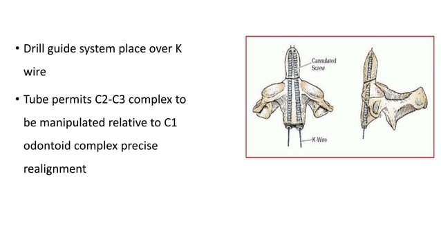 C2 (Axis) cervical Spine Fracture Presentation | PPTX