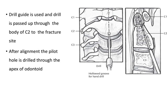 C2 (Axis) cervical Spine Fracture Presentation | PPTX