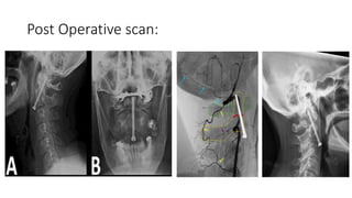 C2 (Axis) cervical Spine Fracture Presentation | PPTX