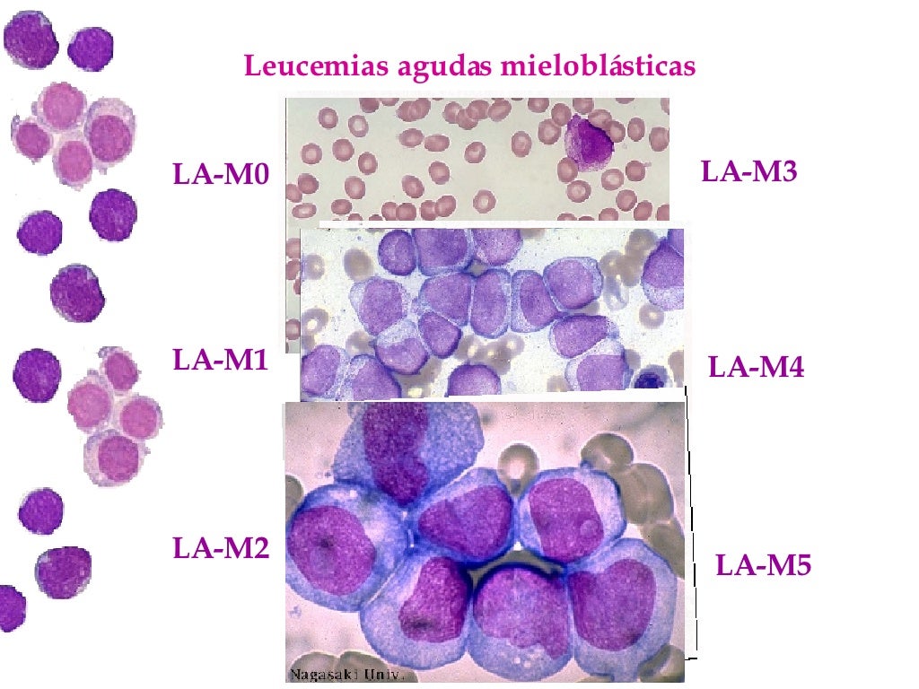 C.2.Leucemias Agudas L&M