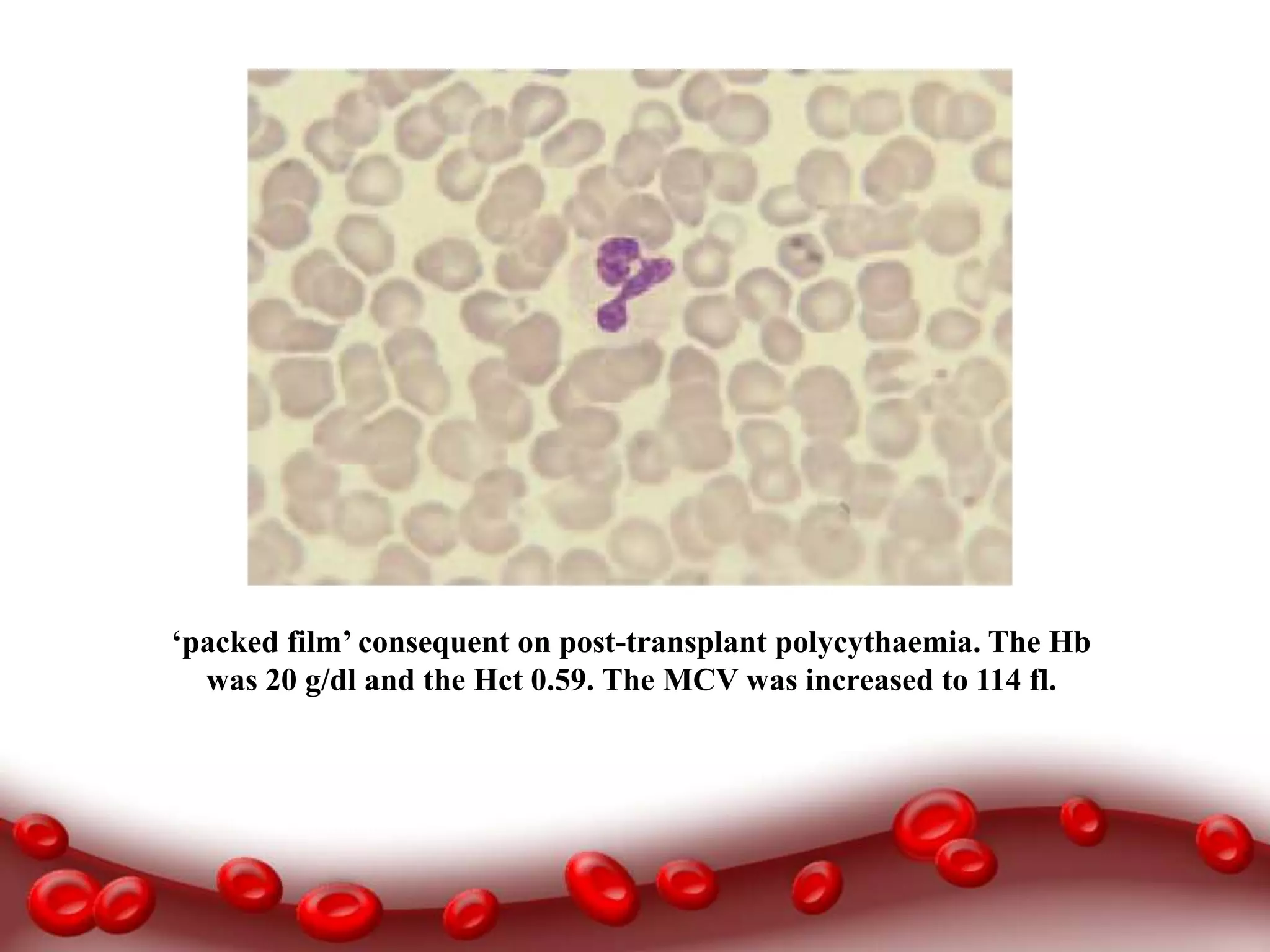 polycythemia | PPTX