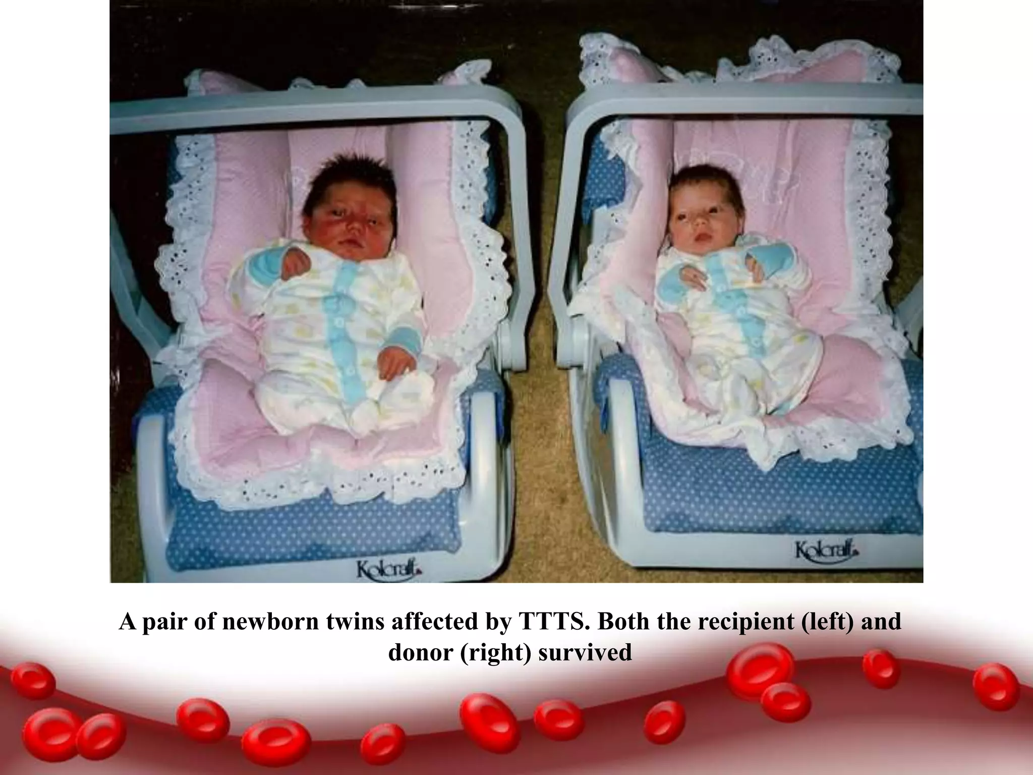 polycythemia | PPTX