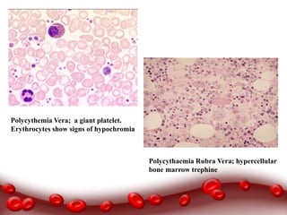 polycythemia | PPTX