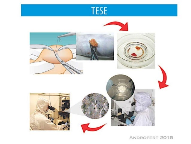 MESA, TESE, MicroTESE