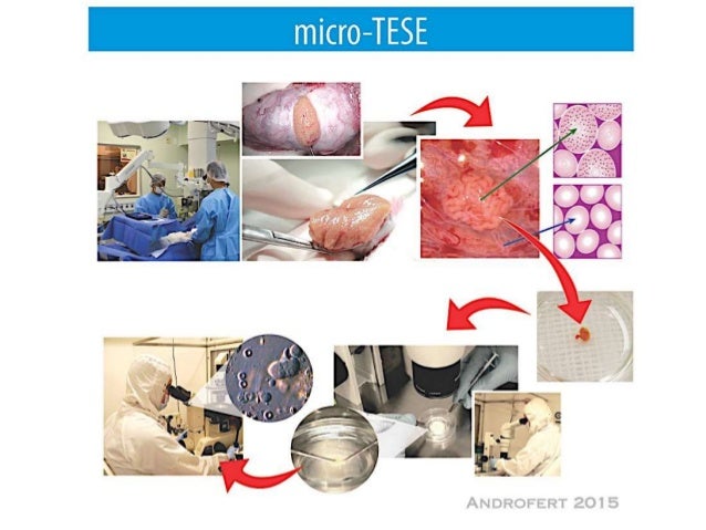MESA, TESE, MicroTESE