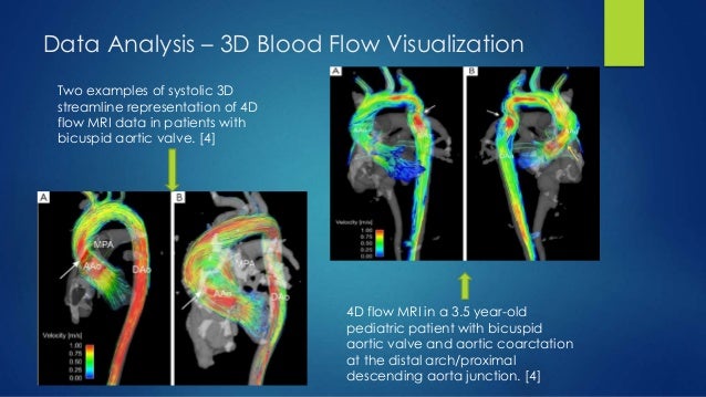 4D Flow MRI