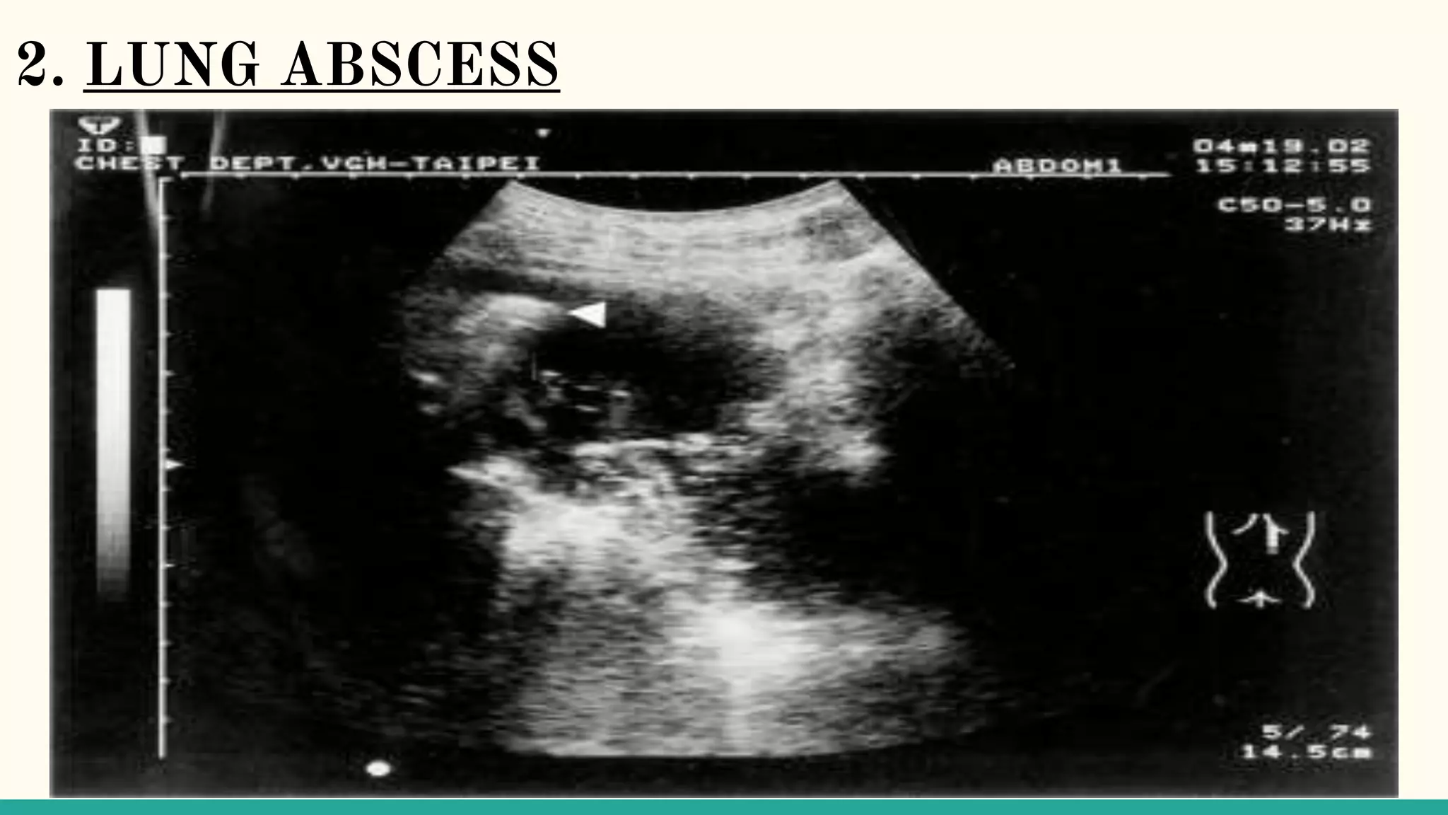 trans thoracic ultrasound of chest | PPTX | Lung and Respiratory Health ...