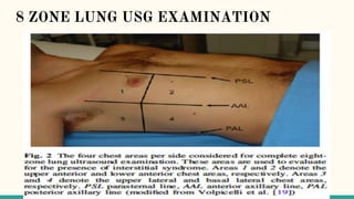 trans thoracic ultrasound of chest | PPT