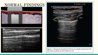 trans thoracic ultrasound of chest | PPT
