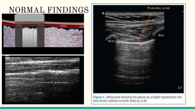 trans thoracic ultrasound of chest | PPTX | Lung and Respiratory Health ...