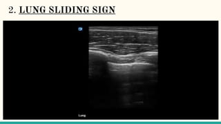 trans thoracic ultrasound of chest | PPT