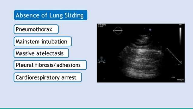 trans thoracic ultrasound of chest | PPTX | Lung and Respiratory Health ...