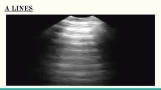 trans thoracic ultrasound of chest | PPT