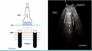 trans thoracic ultrasound of chest | PPT