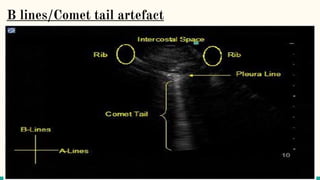 trans thoracic ultrasound of chest | PPT