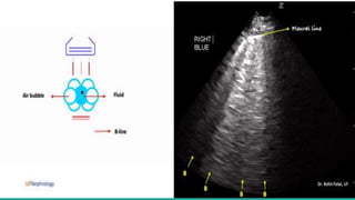 trans thoracic ultrasound of chest | PPT