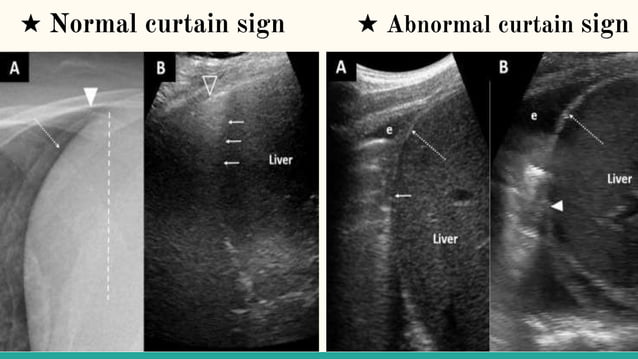 trans thoracic ultrasound of chest | PPTX | Lung and Respiratory Health ...