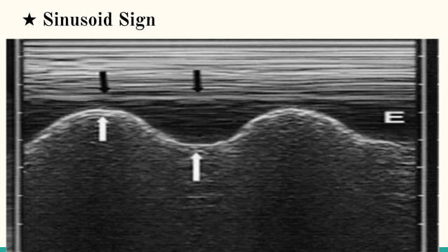 trans thoracic ultrasound of chest | PPTX | Lung and Respiratory Health ...