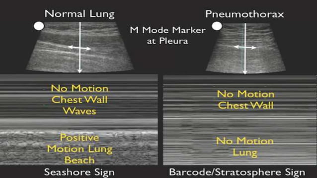 trans thoracic ultrasound of chest | PPTX | Lung and Respiratory Health ...