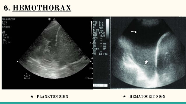 trans thoracic ultrasound of chest | PPTX | Lung and Respiratory Health ...