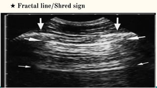 trans thoracic ultrasound of chest | PPT