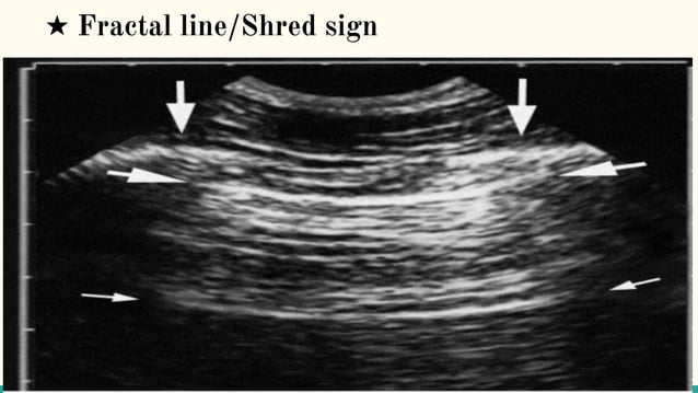 trans thoracic ultrasound of chest | PPTX | Lung and Respiratory Health ...