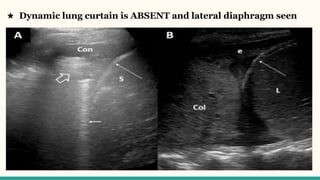trans thoracic ultrasound of chest | PPT