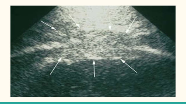 trans thoracic ultrasound of chest | PPTX | Lung and Respiratory Health ...