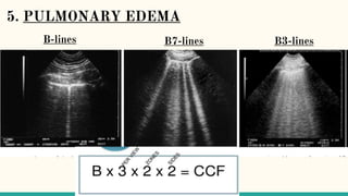 trans thoracic ultrasound of chest | PPT