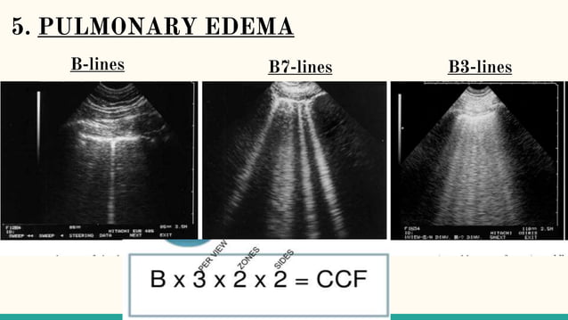 trans thoracic ultrasound of chest | PPTX | Lung and Respiratory Health ...