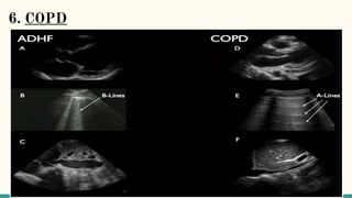 trans thoracic ultrasound of chest | PPT