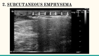 trans thoracic ultrasound of chest | PPT