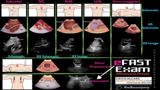 trans thoracic ultrasound of chest | PPT