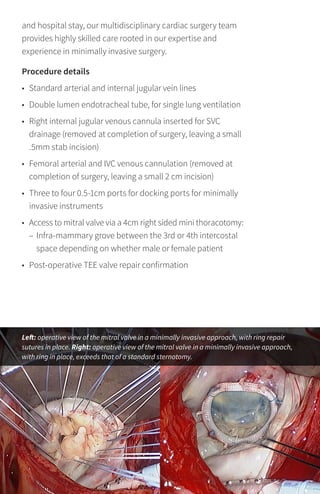 mini-mitral-br-v11 | PDF | Heart and Cardiovascular Diseases | Diseases ...
