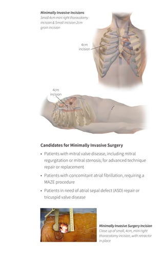 mini-mitral-br-v11 | PDF | Heart and Cardiovascular Diseases | Diseases ...
