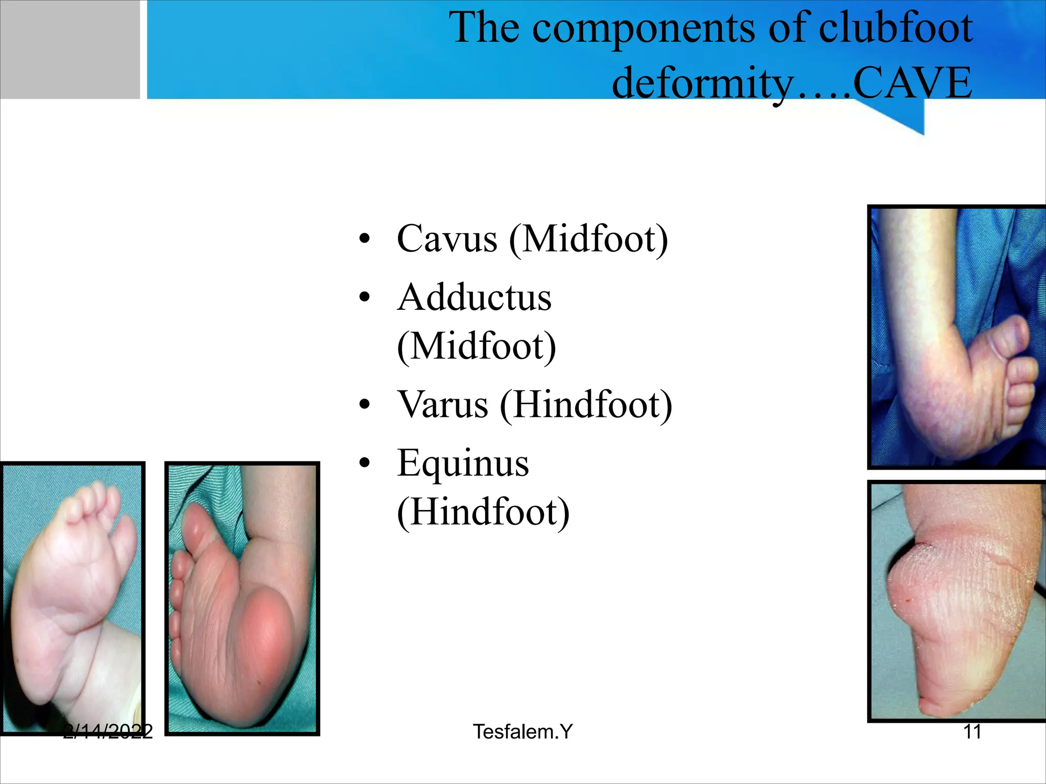 c5 cong.Club foot.pdf