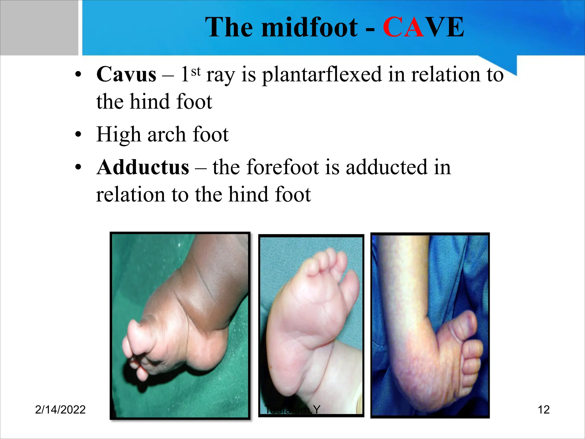 c5 cong.Club foot.pdf