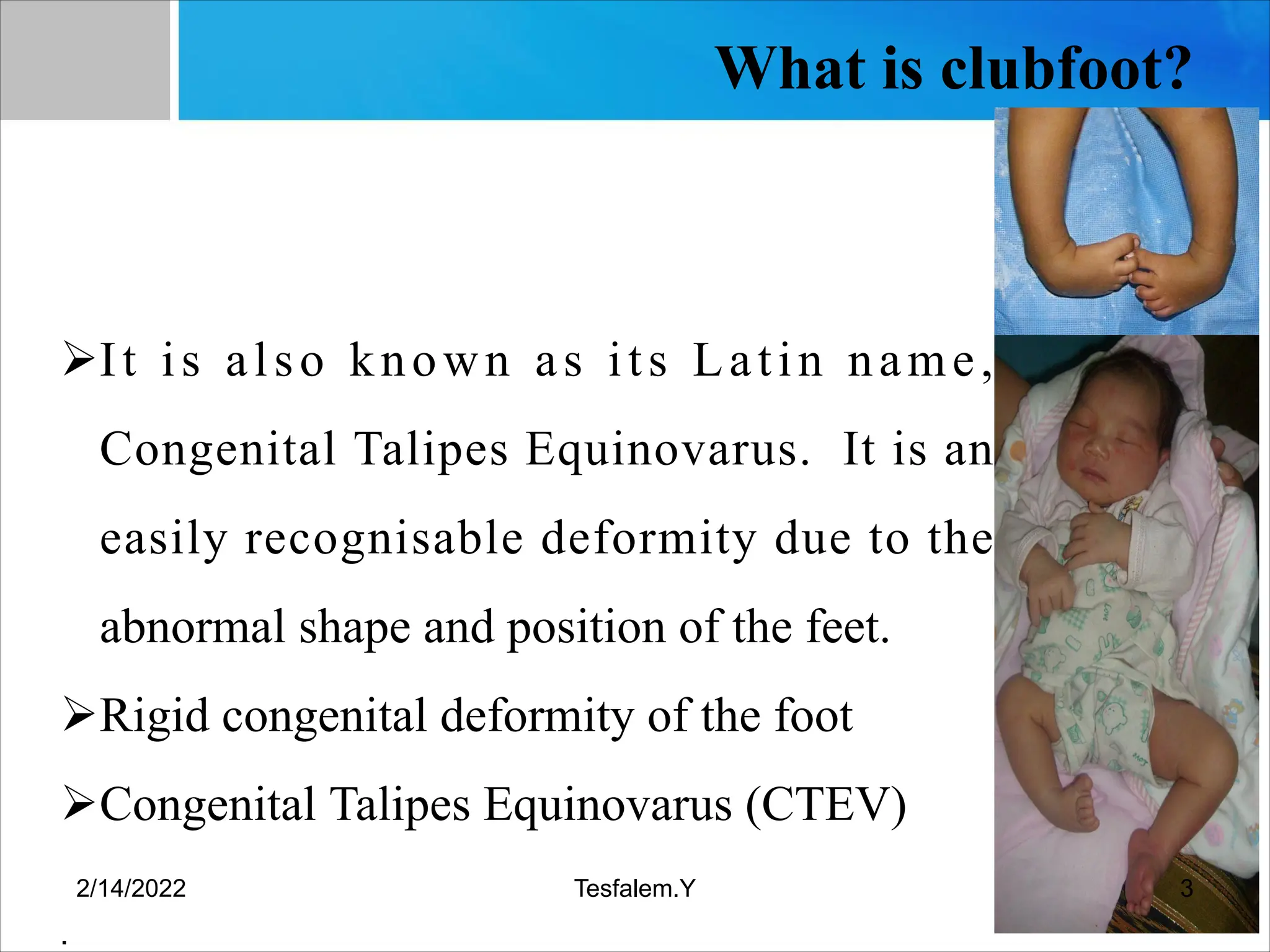 c5 cong.Club foot.pdf