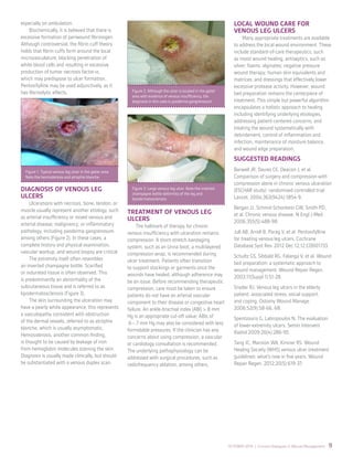 Acelity Global Newsletter | PDF