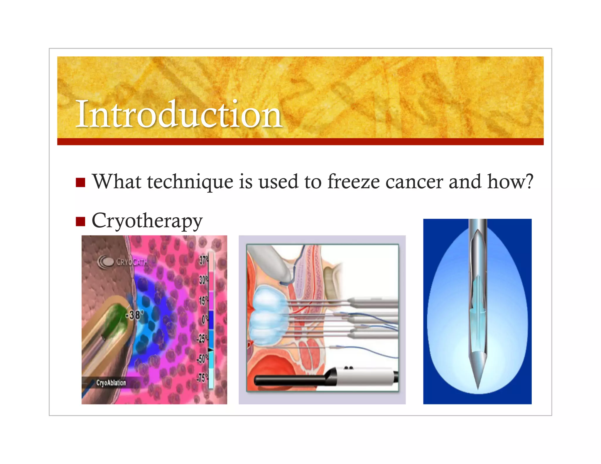 freezing Cancer | PDF