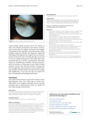 12. Meniscal flounce | PDF