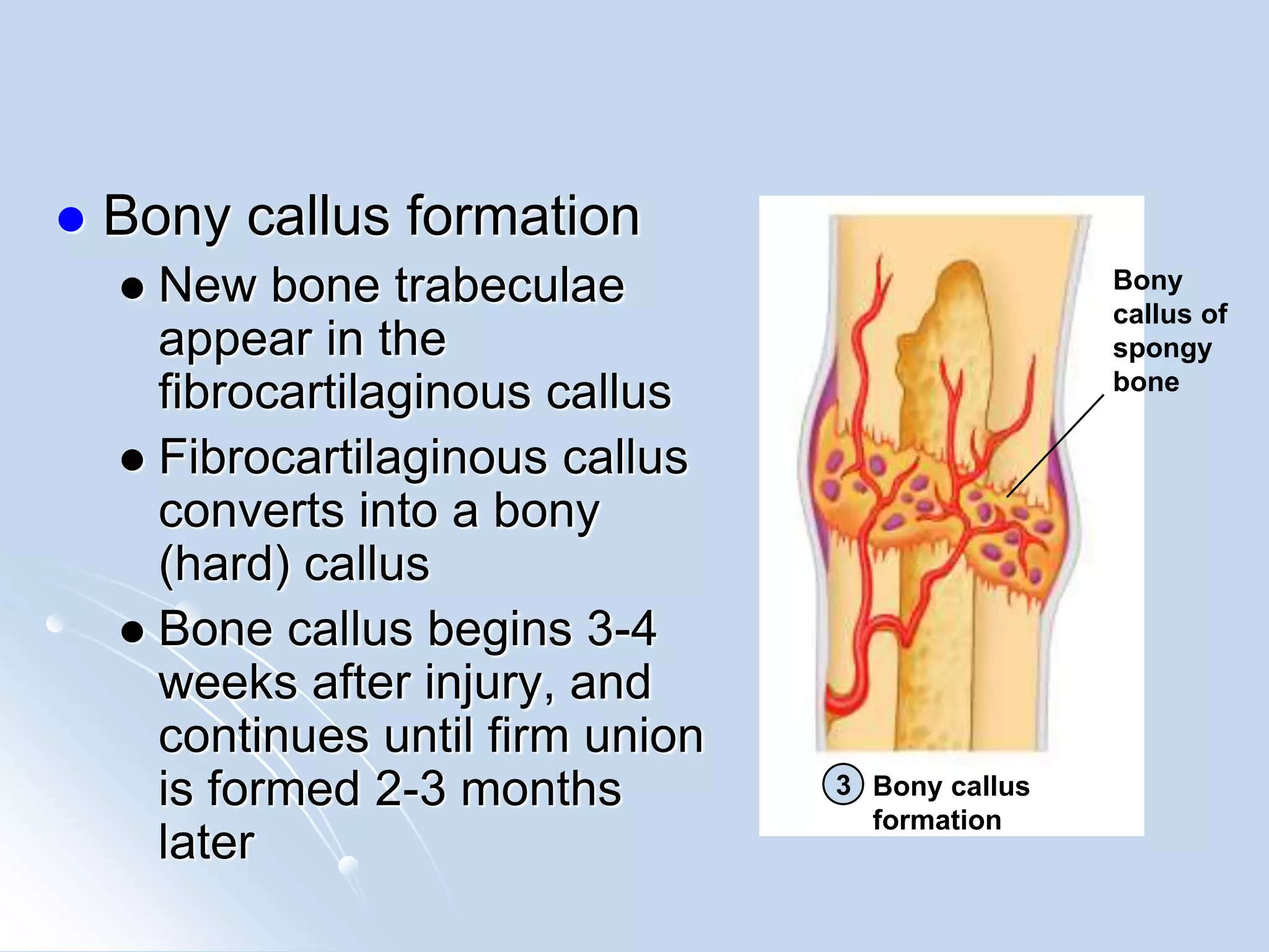 Fracture- its types and process of bone healing. | PPT