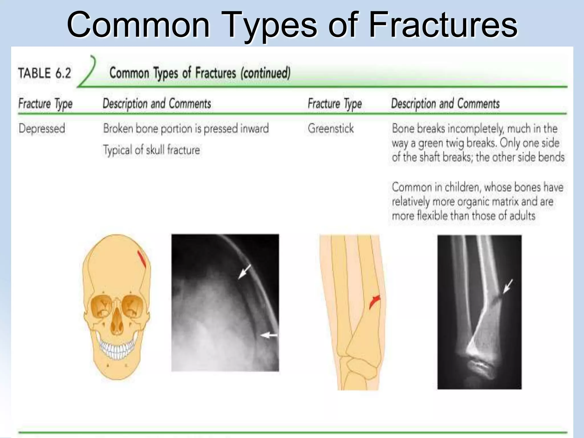 Fracture- its types and process of bone healing. | PPT