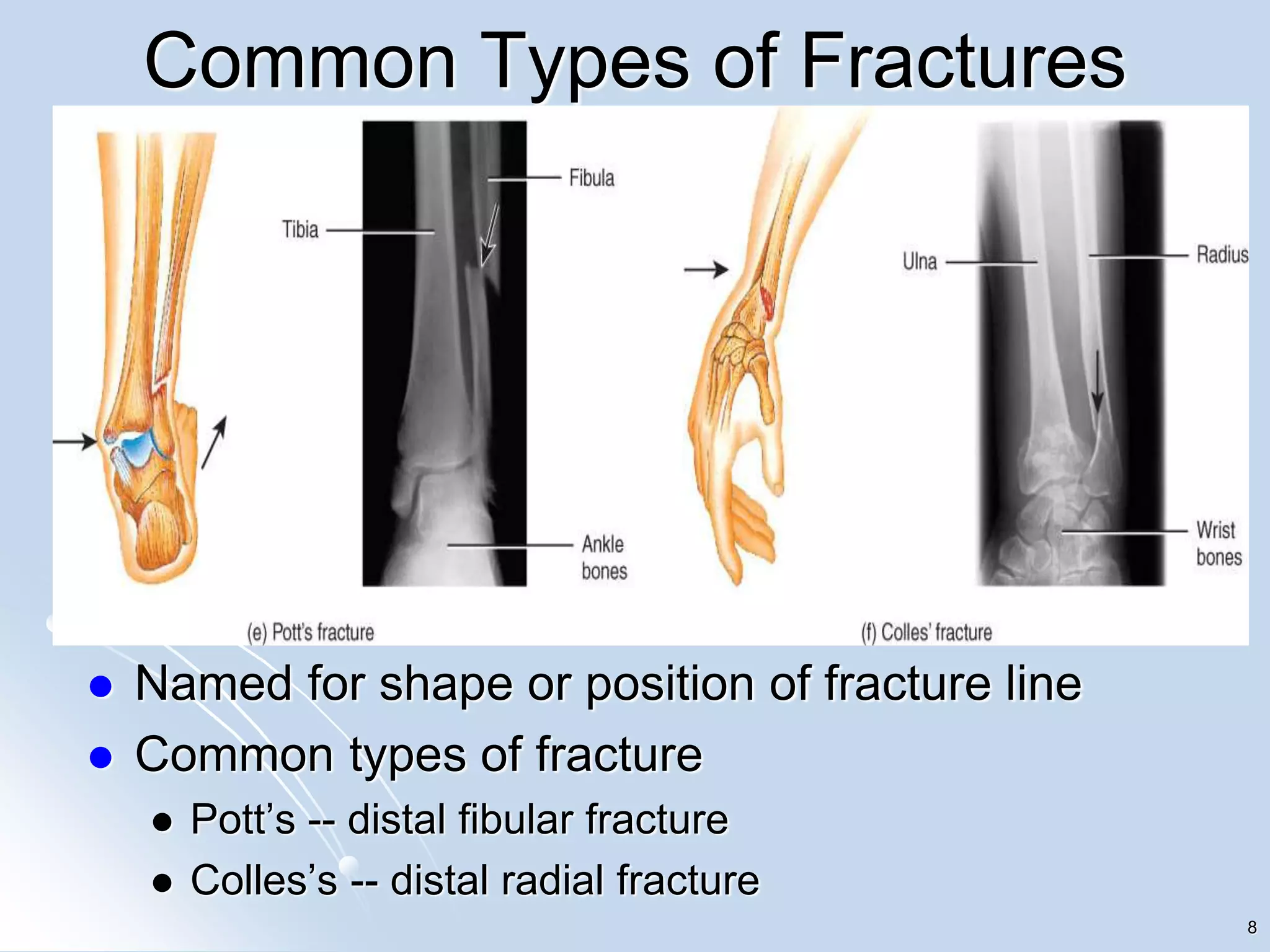 Fracture- its types and process of bone healing. | PPT