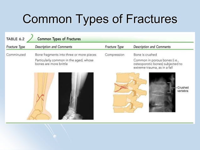 Fracture- its types and process of bone healing. | PPT