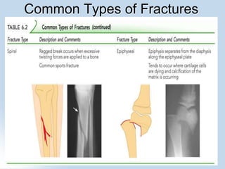 Fracture- its types and process of bone healing. | PPT