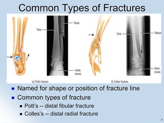 Fracture- its types and process of bone healing. | PPT
