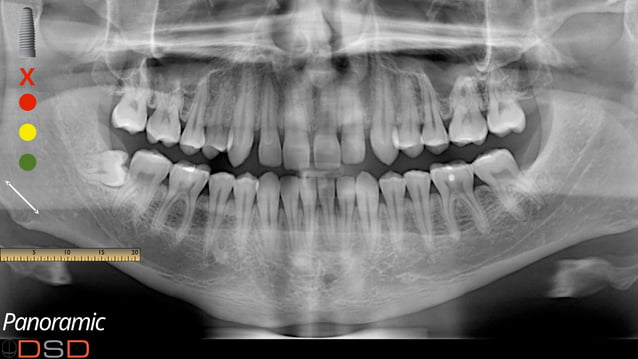digital smile design template for smile analysis | PPT
