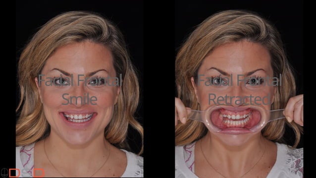 digital smile design template for smile analysis | PPT